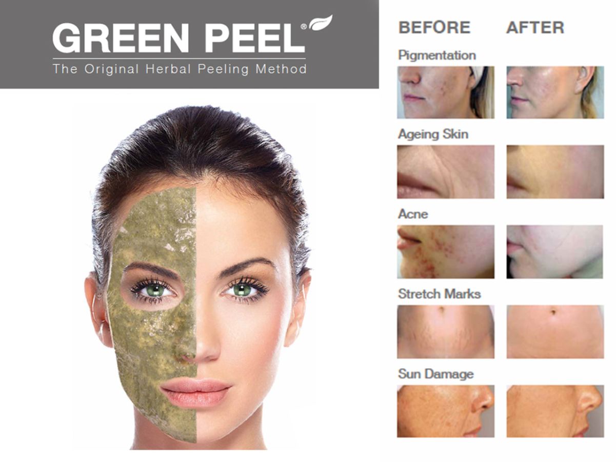 Dermabrasion – Green/Chemical Peeling – Medi Aesthetics